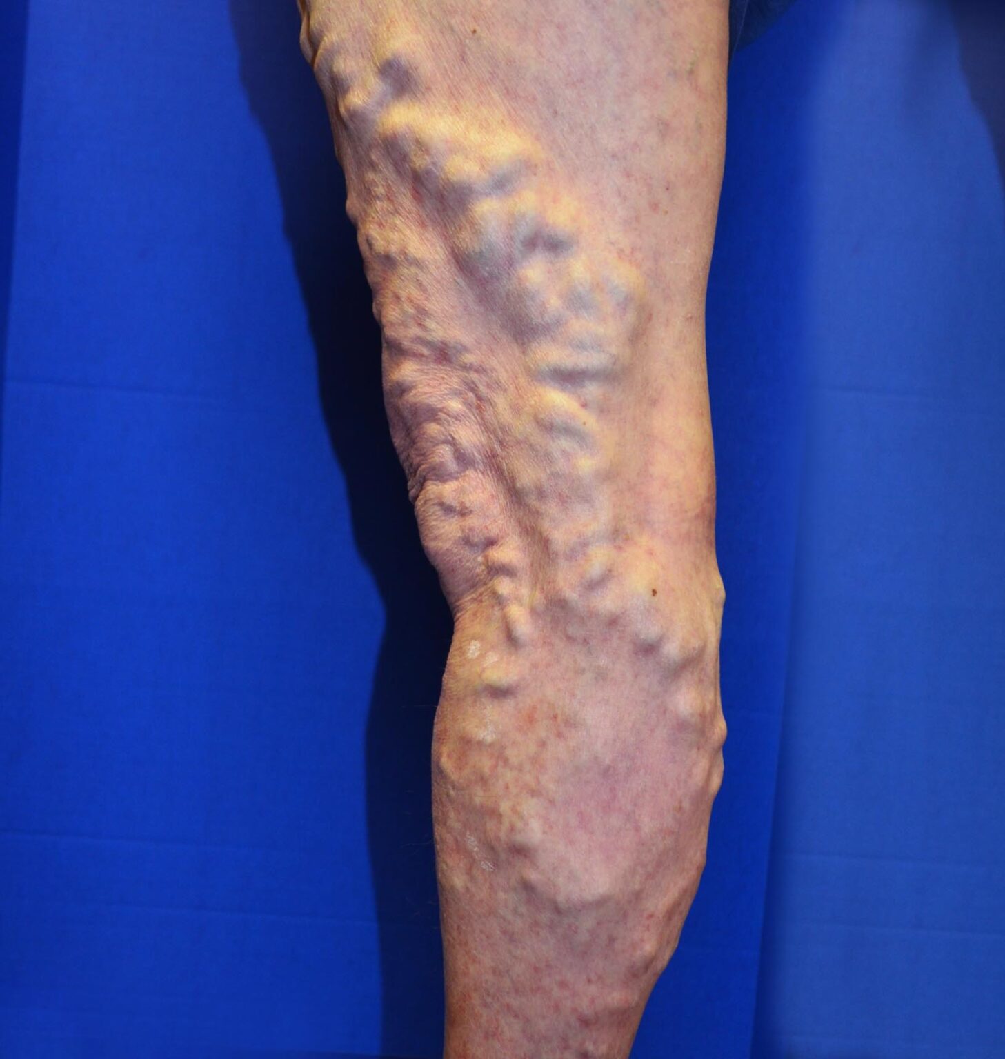 Home - New York Vein Treatment Center