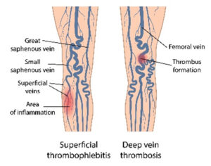 Superficial Thrombophlebitis - New York Vein Treatment Center