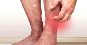 Symptoms of DVT in Legs - New York Vein Treatment Center