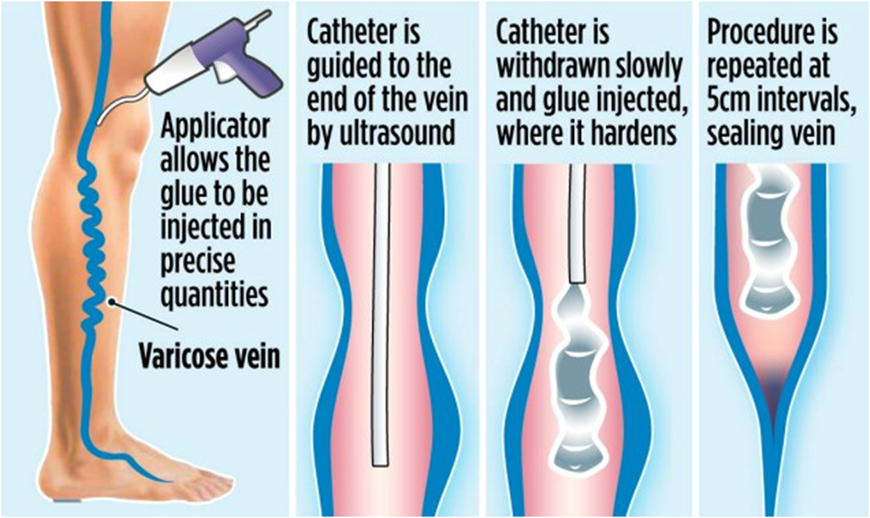 VenaSeal Treatment - New York Vein Treatment Center