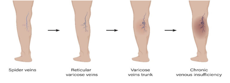 Chronic Venous Insufficiency Specialist - New York Vein Treatment Center
